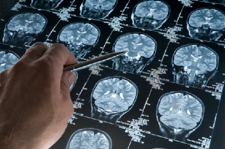 Alzheimer: fasi e gestione della malattia
