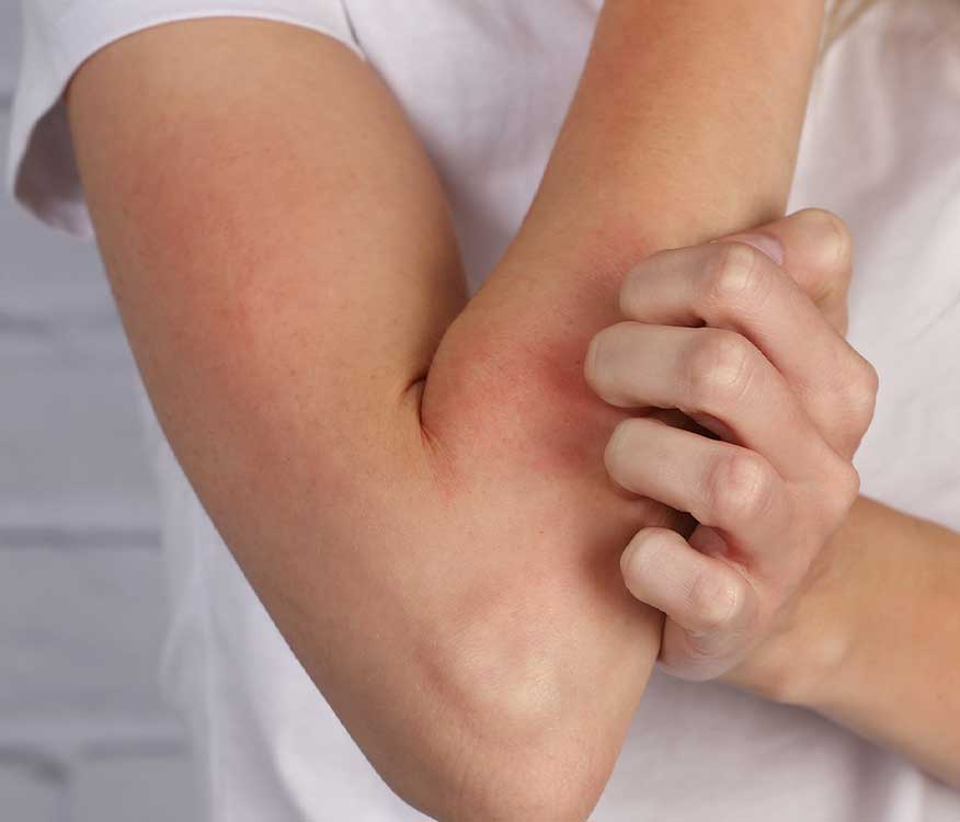 Ferkelan Crema e Gel per la Pelle | BioNike